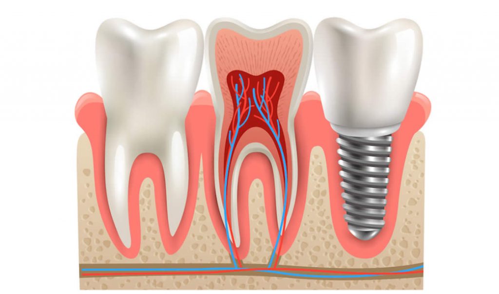 Toronto Dental Implants Dentist | Implant Dentistry from Start to ...